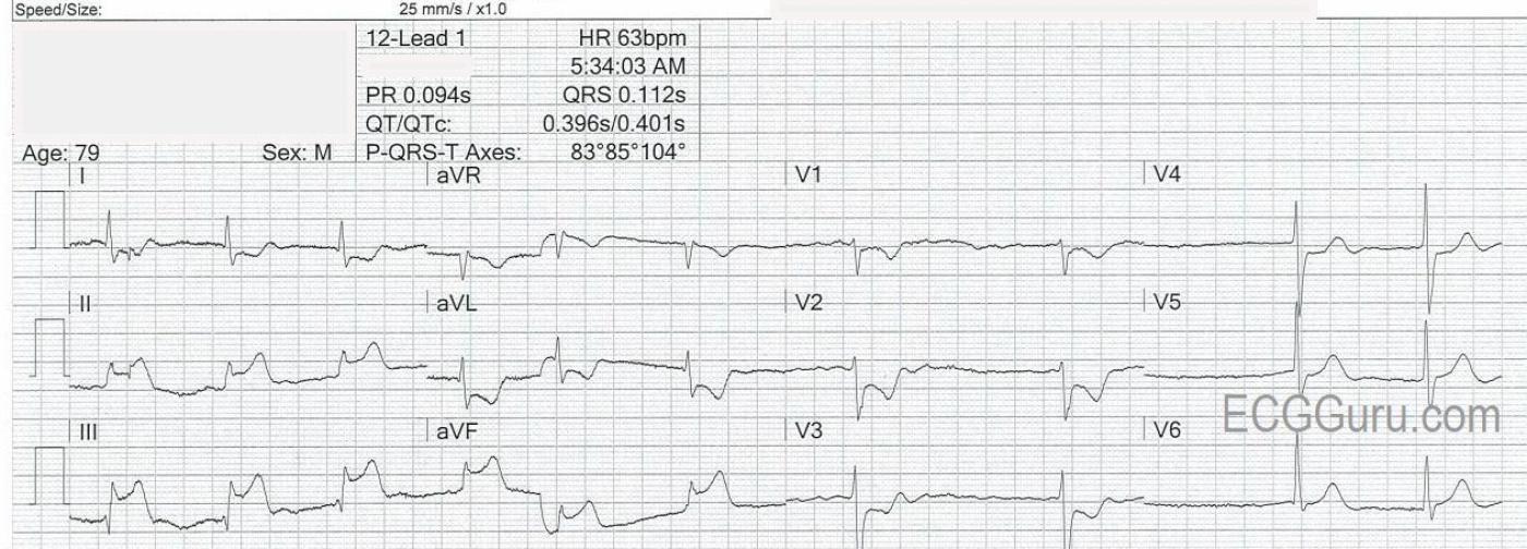 Inferior Wall, Posterior Wall, and Right Ventricular M.I. | ECG Guru ... Inferior Wall, Posterior Wall, and Right Ventricular M.I. | ECG Guru ...